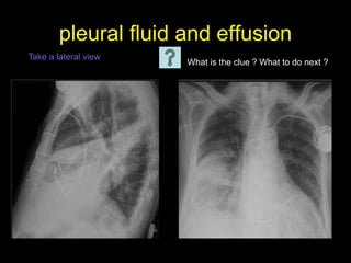 basic approach for CXR interpretation | PPTX