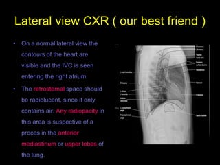 basic approach for CXR interpretation | PPTX