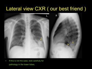 basic approach for CXR interpretation | PPTX