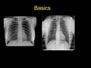 basic approach for CXR interpretation | PPTX