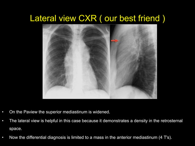 basic approach for CXR interpretation | PPTX