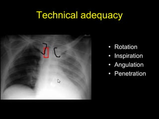 basic approach for CXR interpretation | PPTX