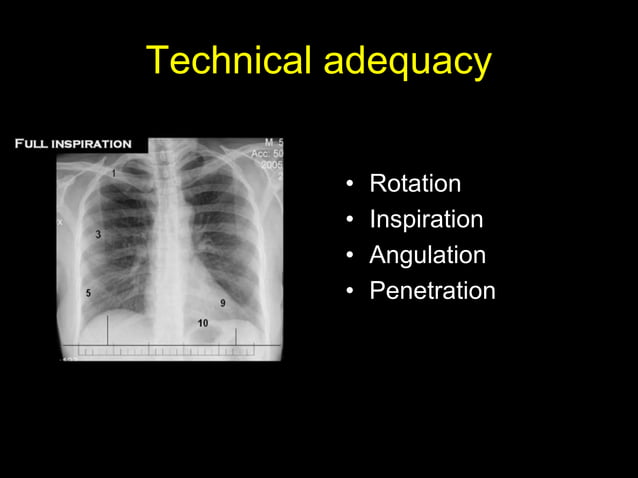 basic approach for CXR interpretation | PPTX