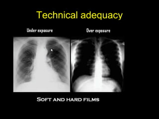 basic approach for CXR interpretation | PPTX