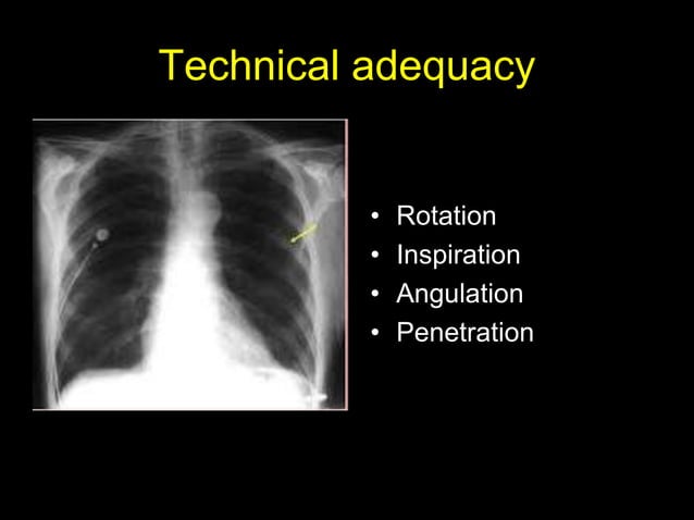 basic approach for CXR interpretation | PPTX