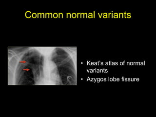 basic approach for CXR interpretation | PPTX