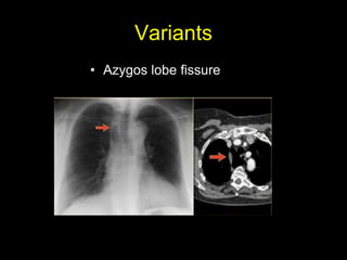 basic approach for CXR interpretation | PPTX