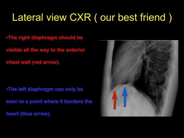 basic approach for CXR interpretation