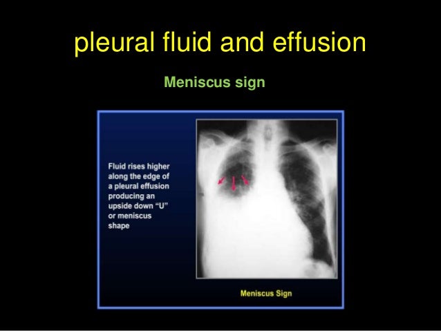 basic approach for CXR interpretation