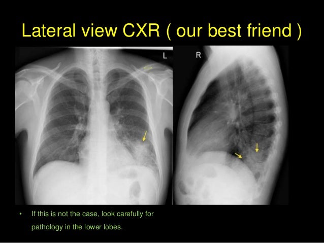 basic approach for CXR interpretation