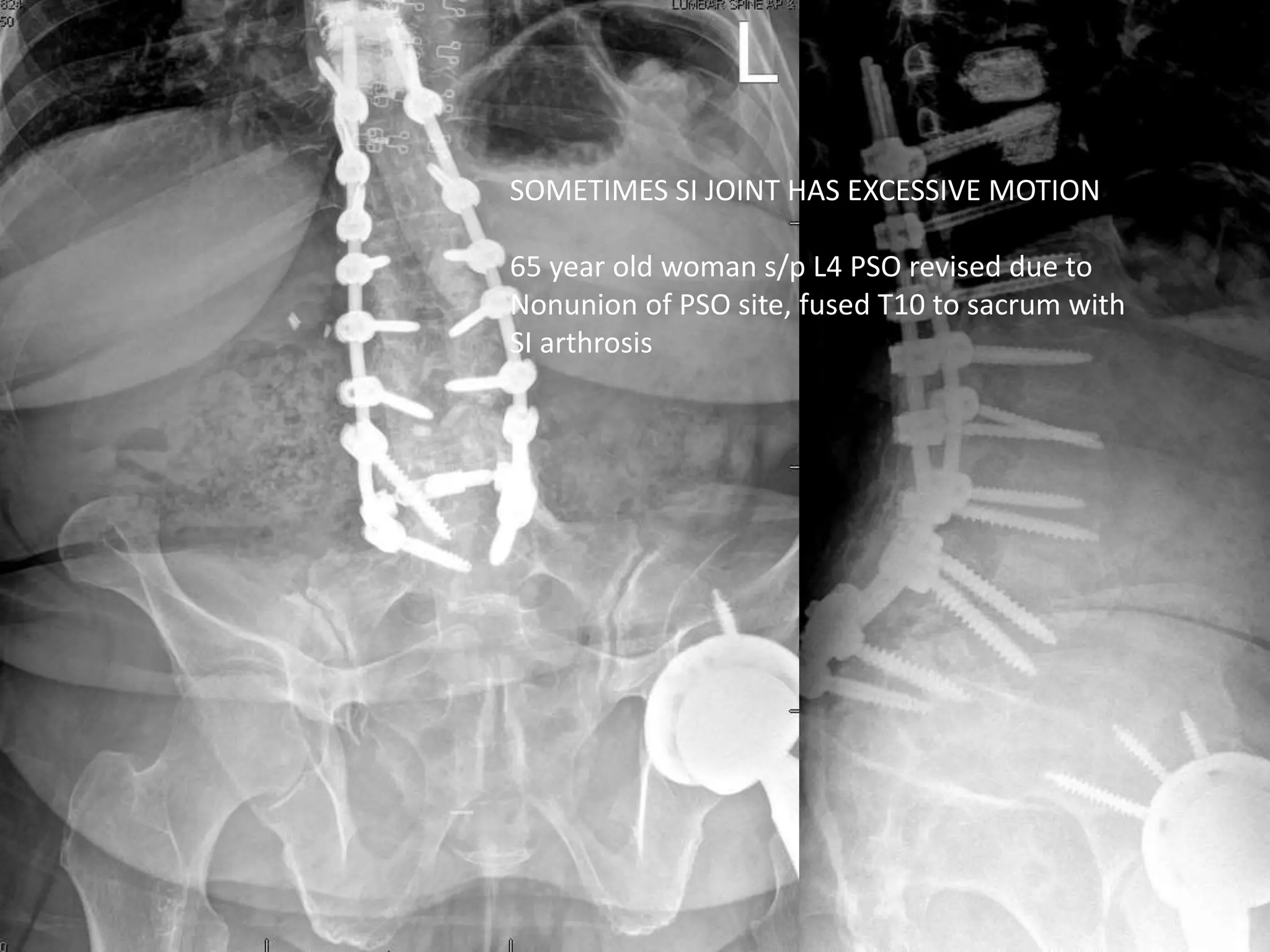 Sacroiliac Joint fusion | PPTX