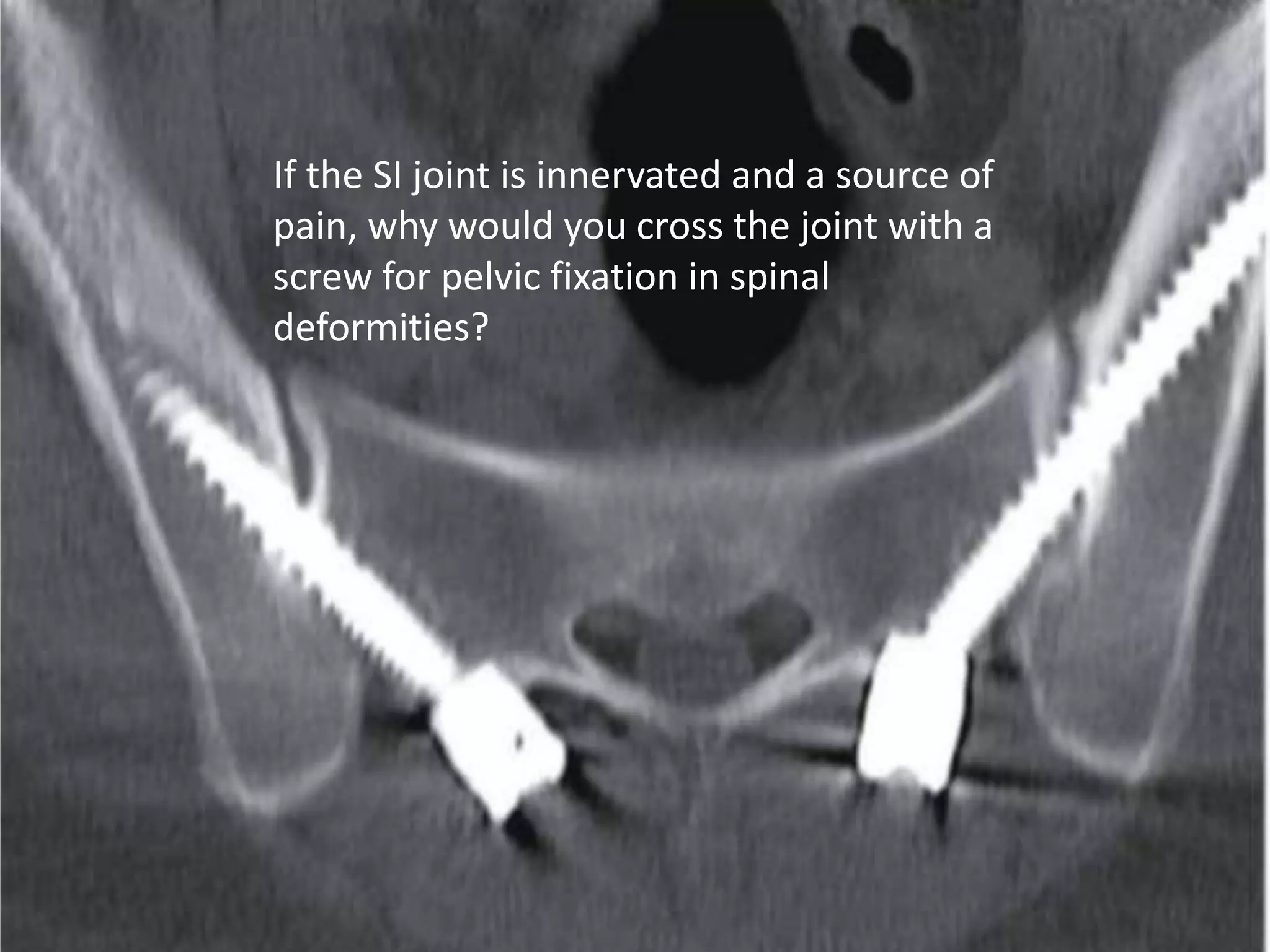 Sacroiliac Joint fusion | PPTX