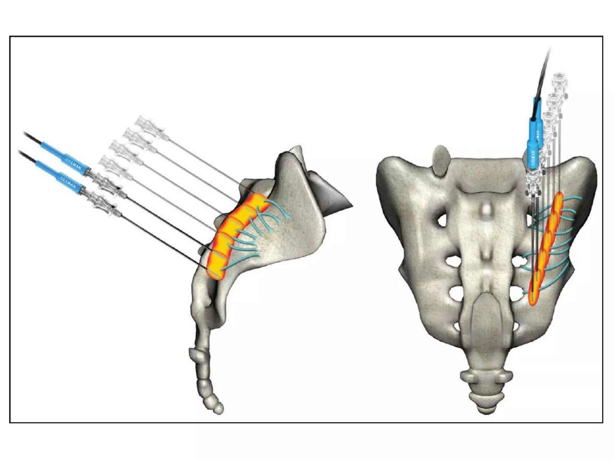 Sacroiliac Joint fusion | PPTX