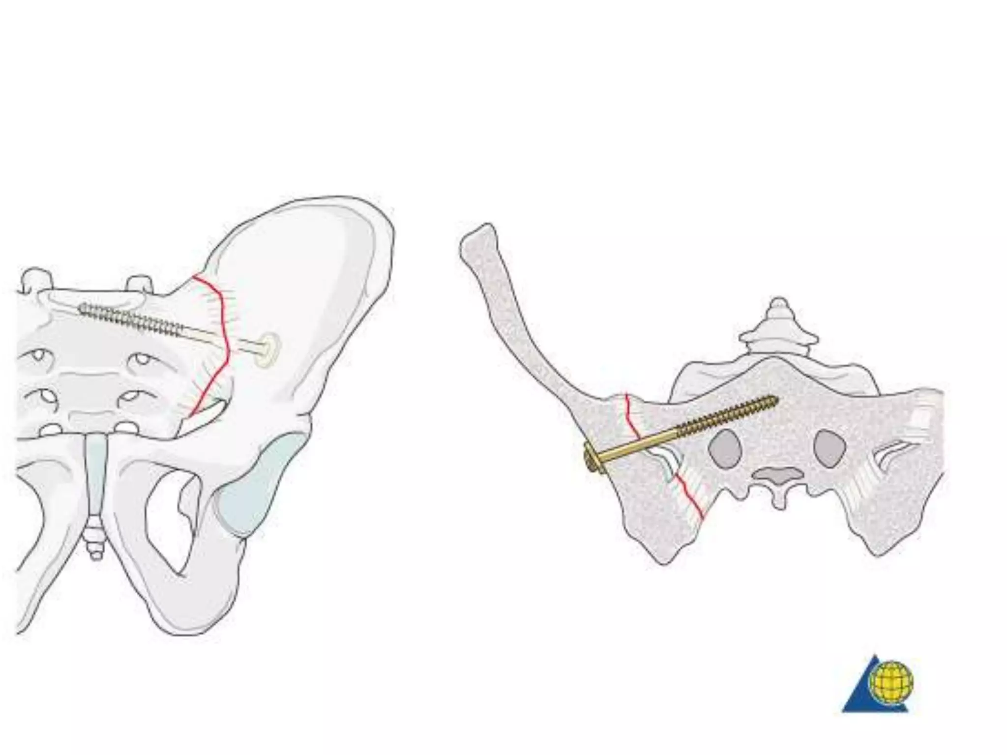Sacroiliac Joint fusion | PPTX
