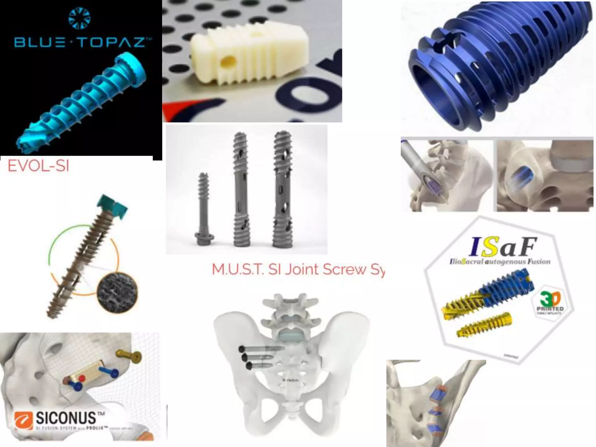 Sacroiliac Joint fusion | PPTX