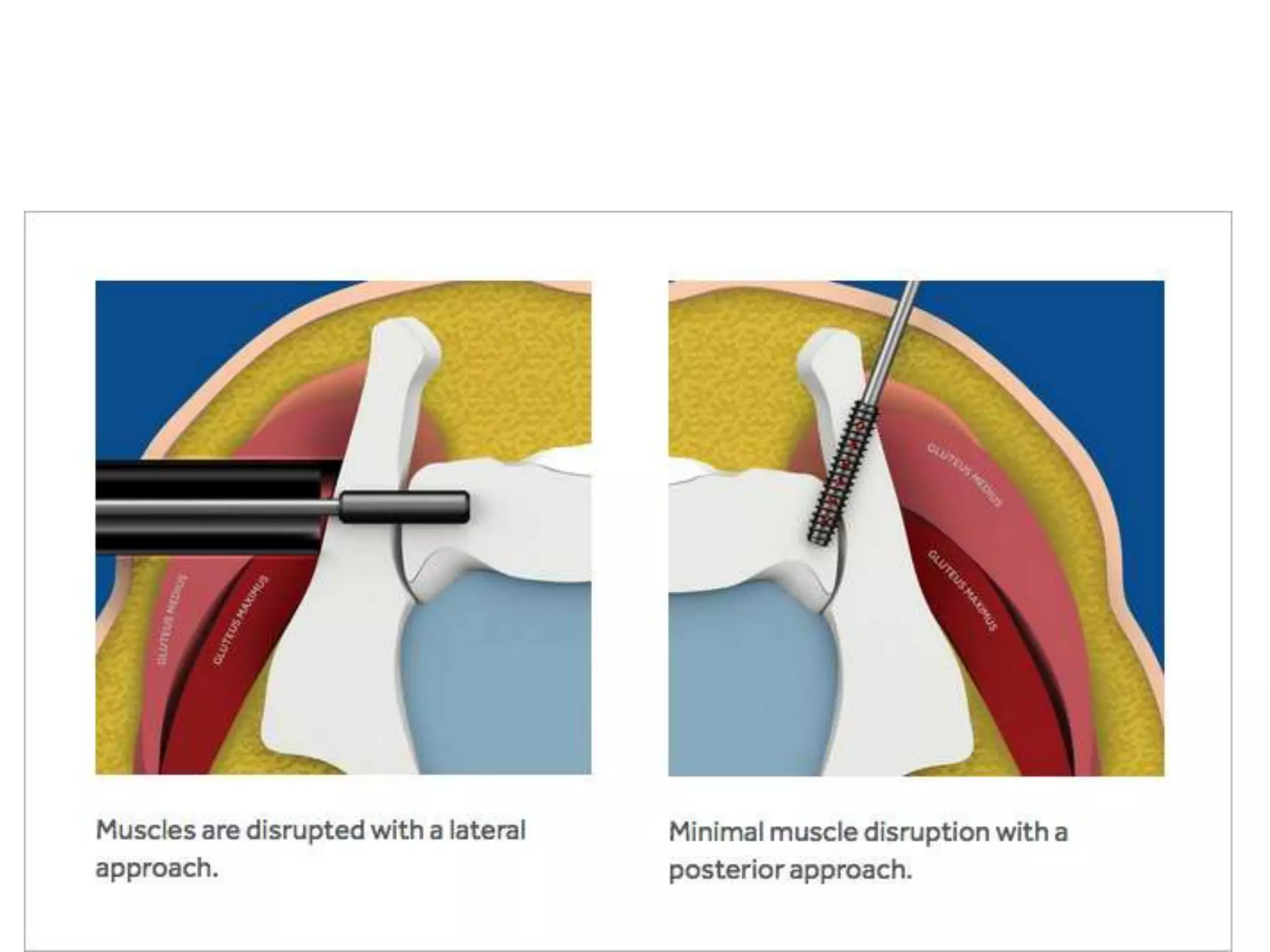 Sacroiliac Joint fusion | PPTX