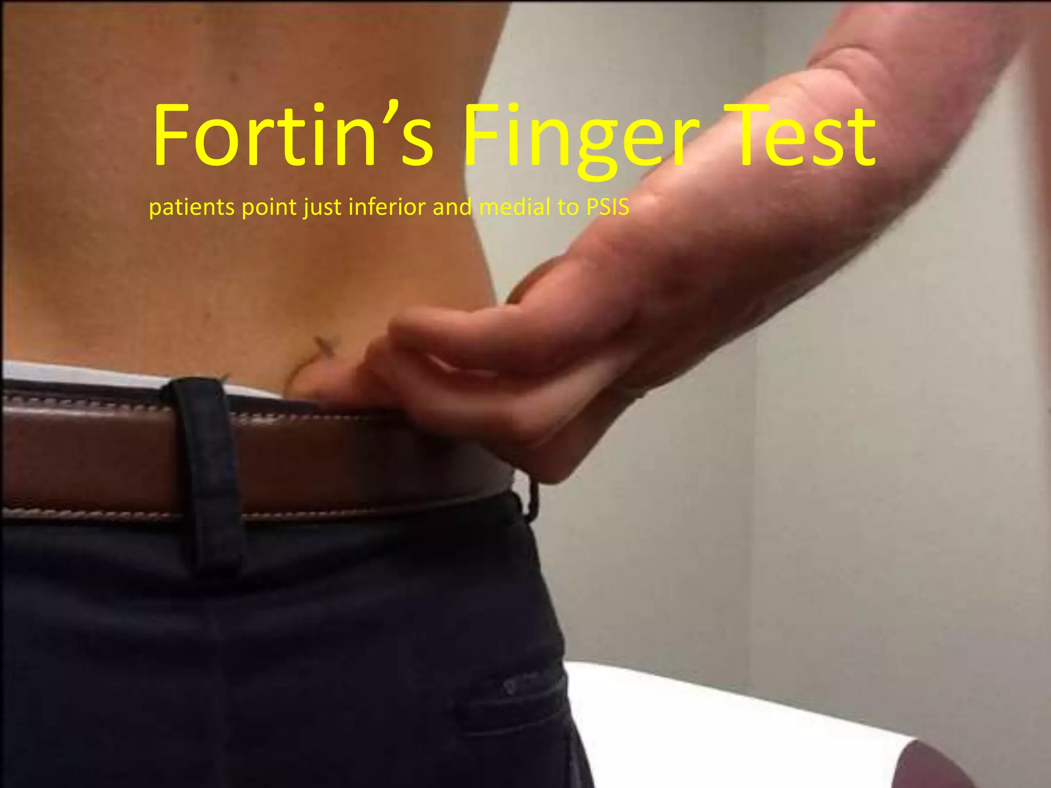 Sacroiliac Joint fusion | PPTX