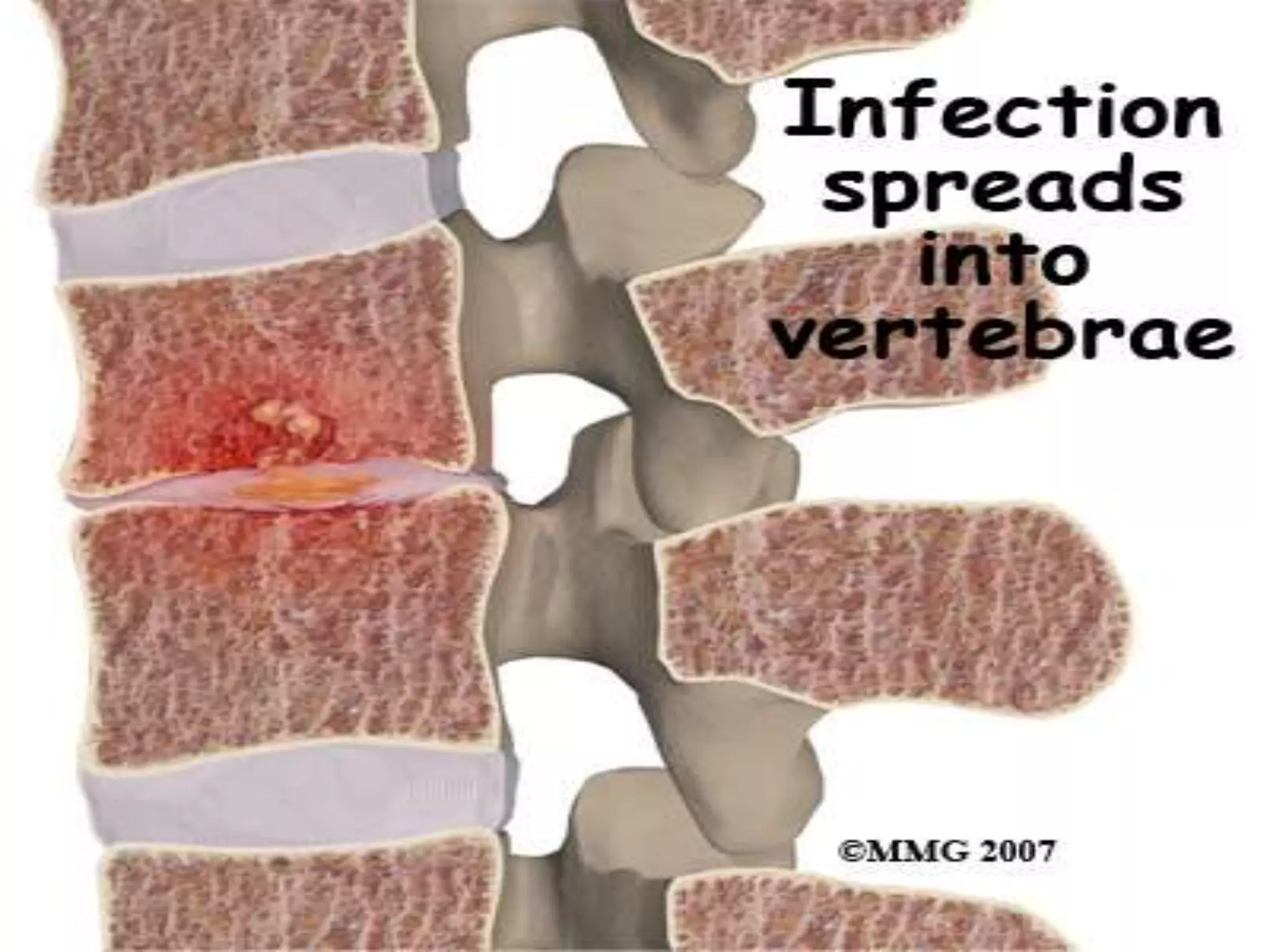 Infections of the spine | PPTX