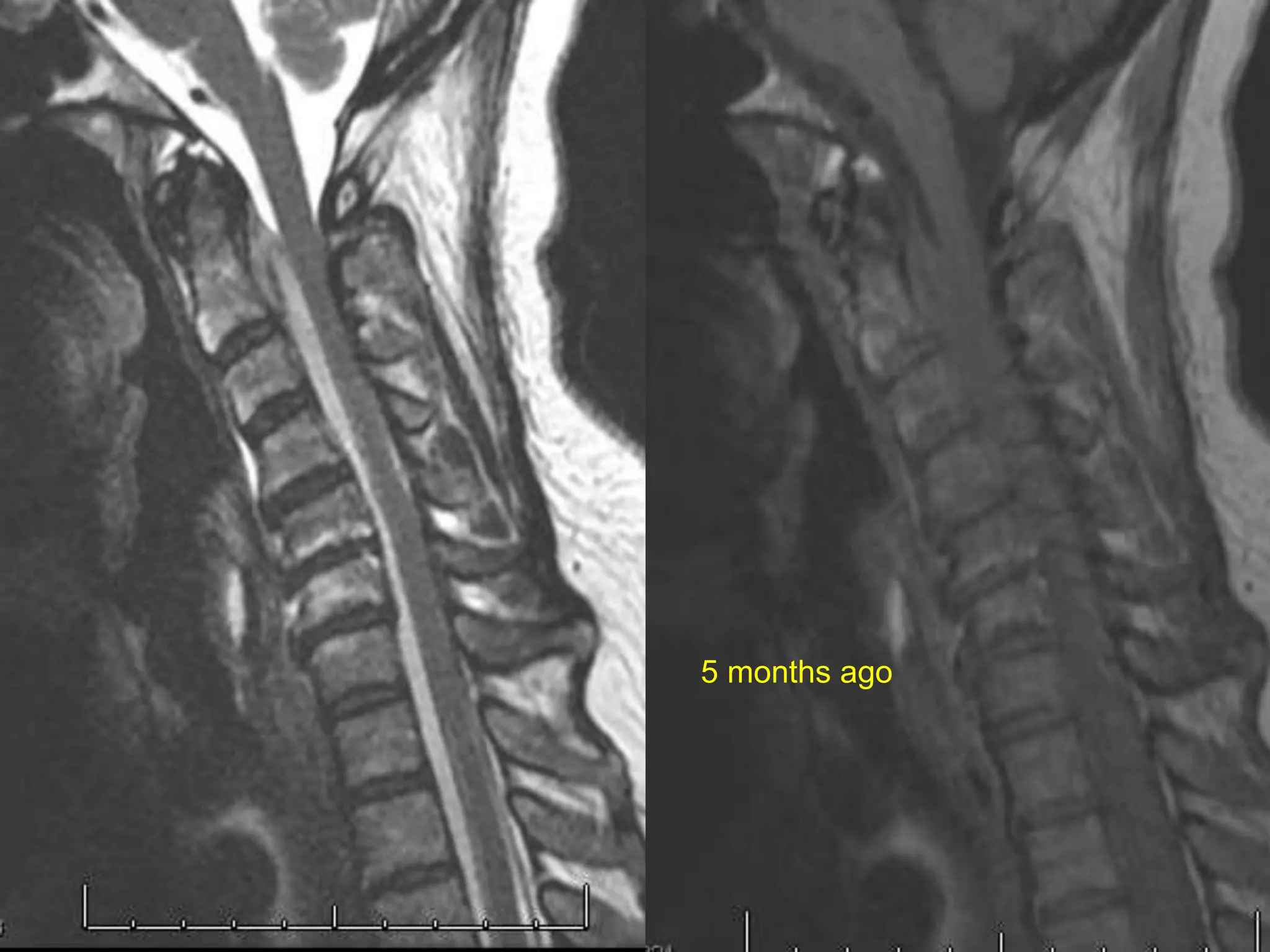 Infections of the spine | PPTX