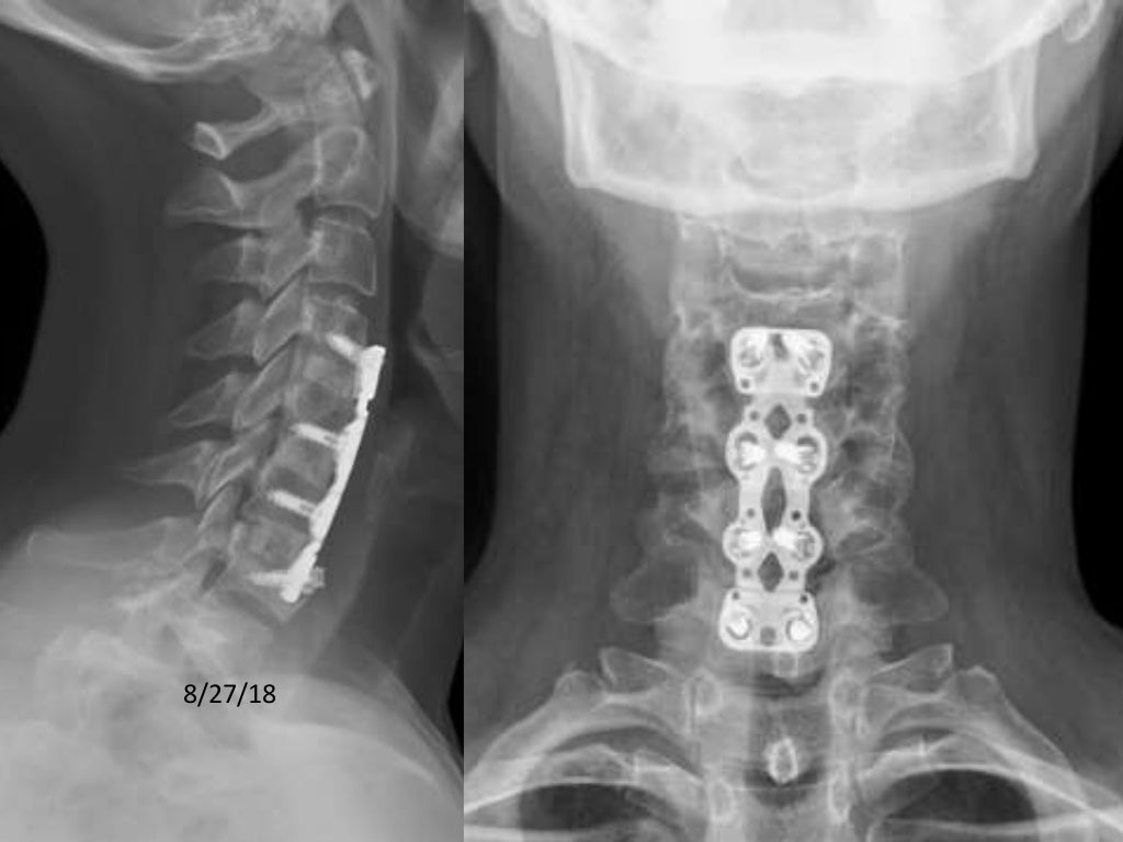 Lecture spine acdf nonunion repair 2018