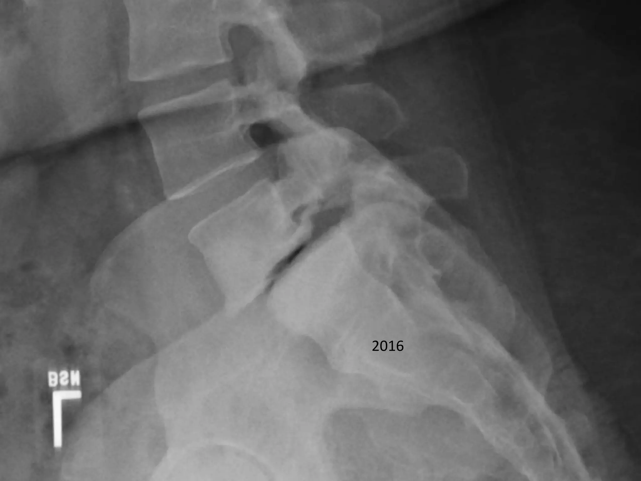 Spine Lecture isthmic spondylolisthesis 2019 march | PPTX