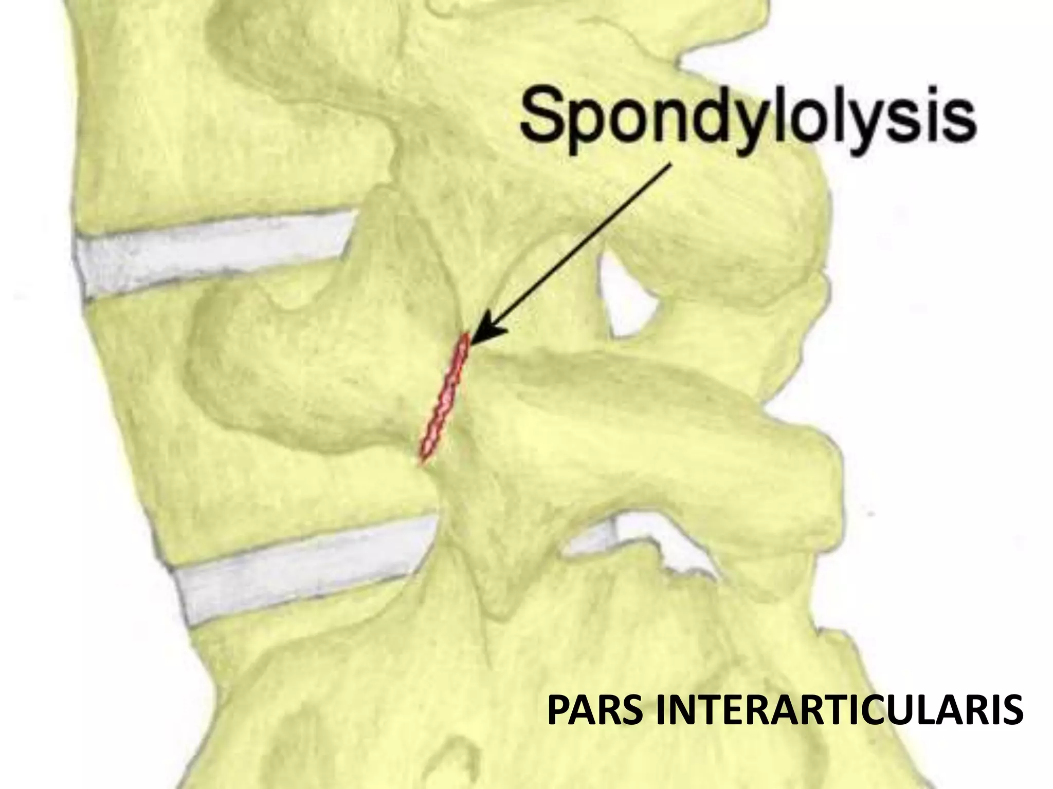 Lecture spondylolysis 2021 | PPTX
