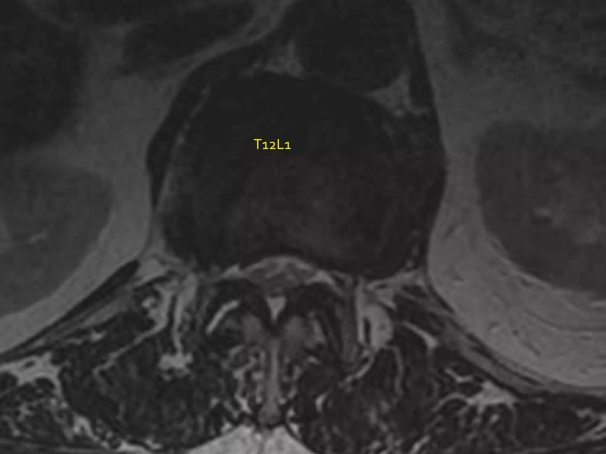Lumbar Spinal Stenosis ULBD technique | PPTX