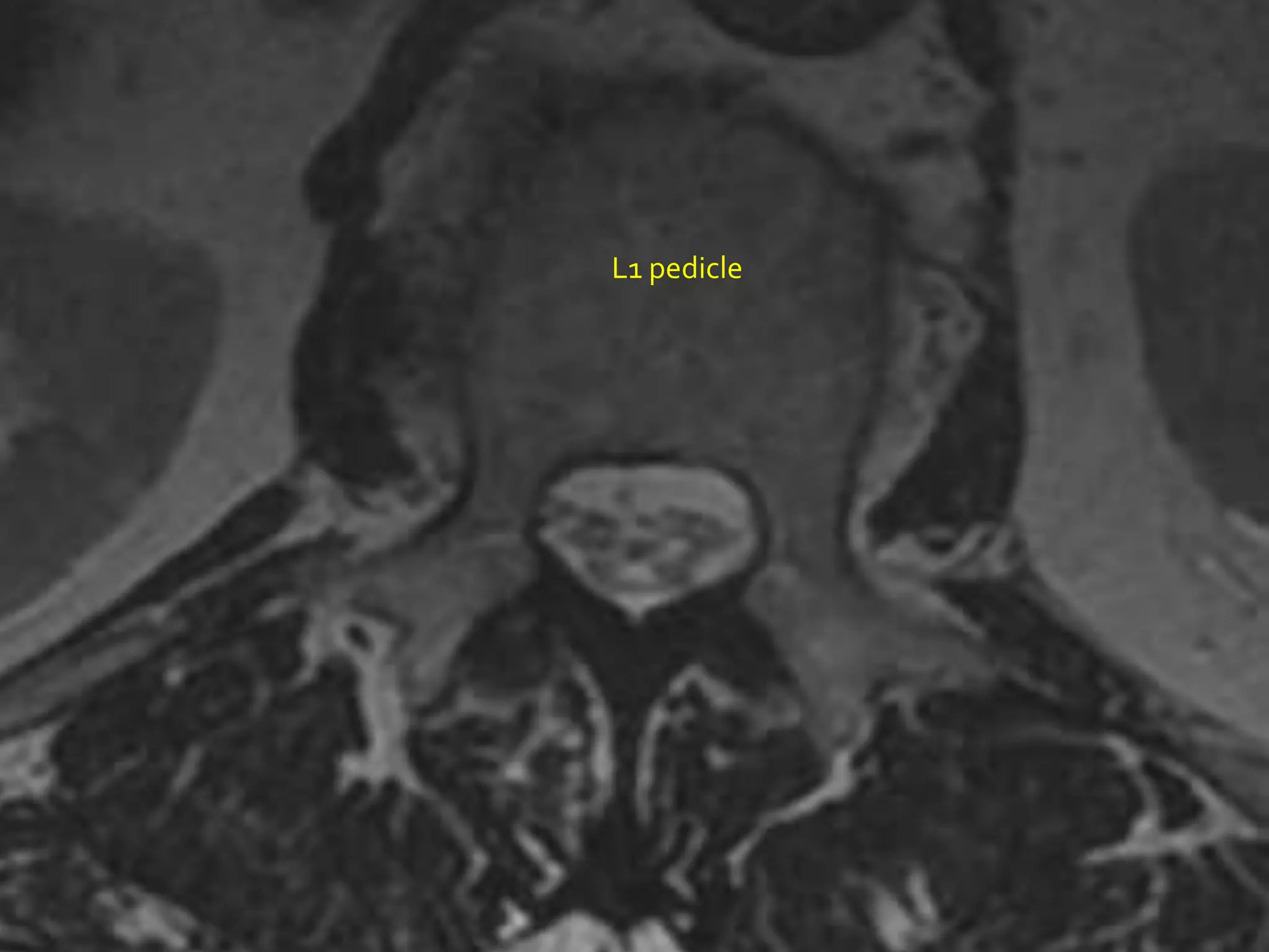 Lumbar Spinal Stenosis ULBD technique | PPTX