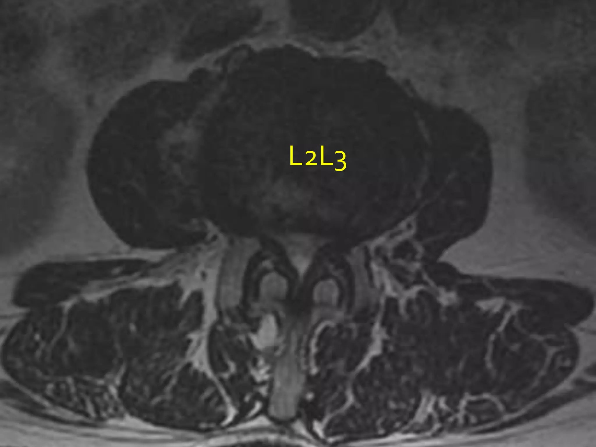 Lumbar Spinal Stenosis ULBD technique | PPTX