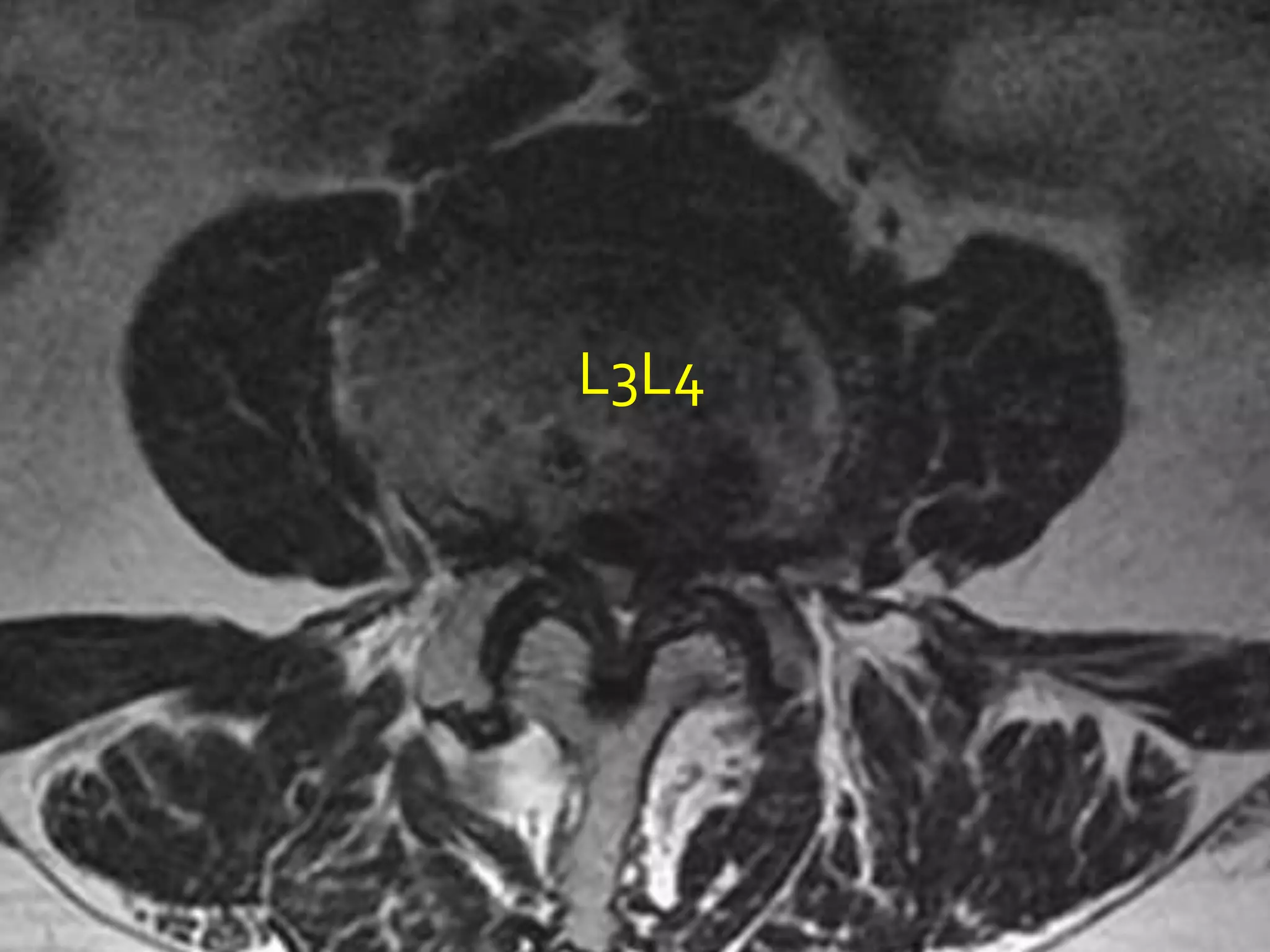 Lumbar Spinal Stenosis ULBD technique | PPTX