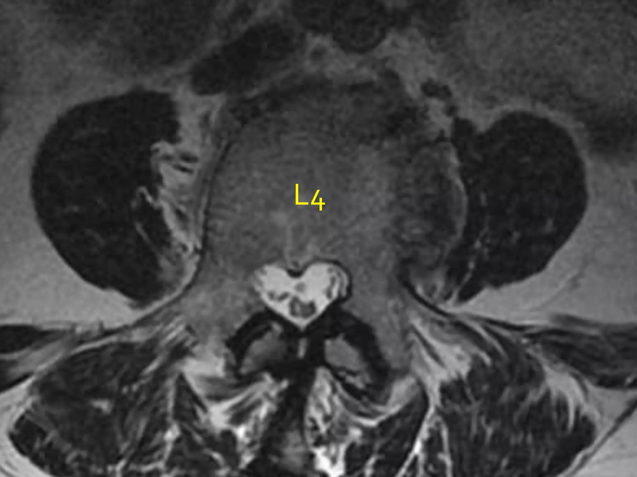 Lumbar Spinal Stenosis ULBD technique | PPTX