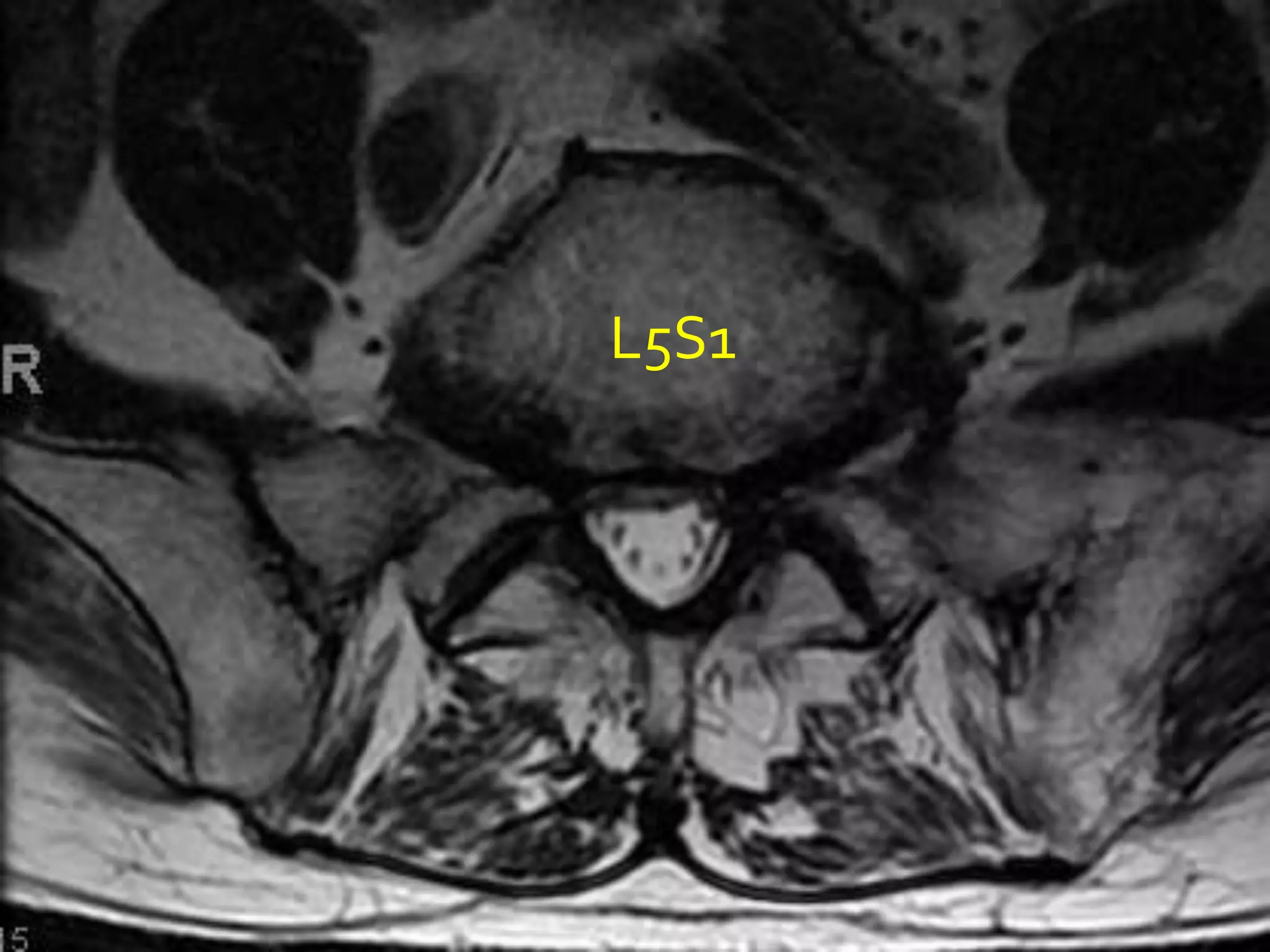 Lumbar Spinal Stenosis ULBD technique | PPTX
