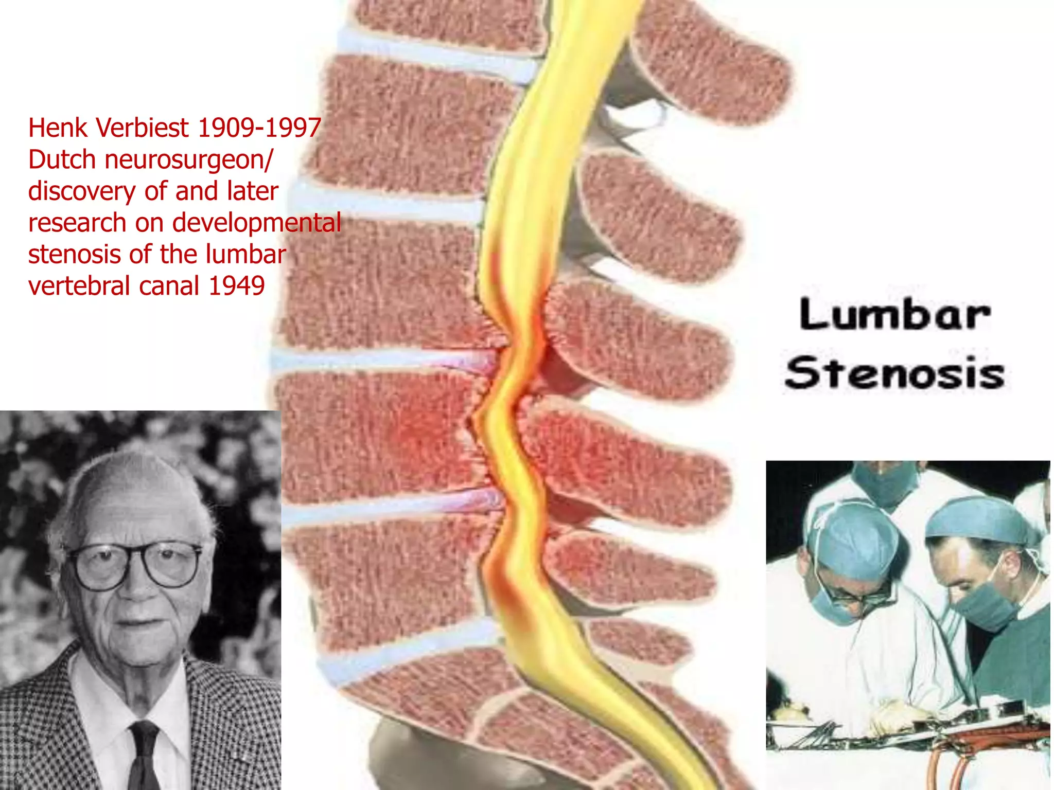 Lumbar Spinal Stenosis ULBD technique | PPTX