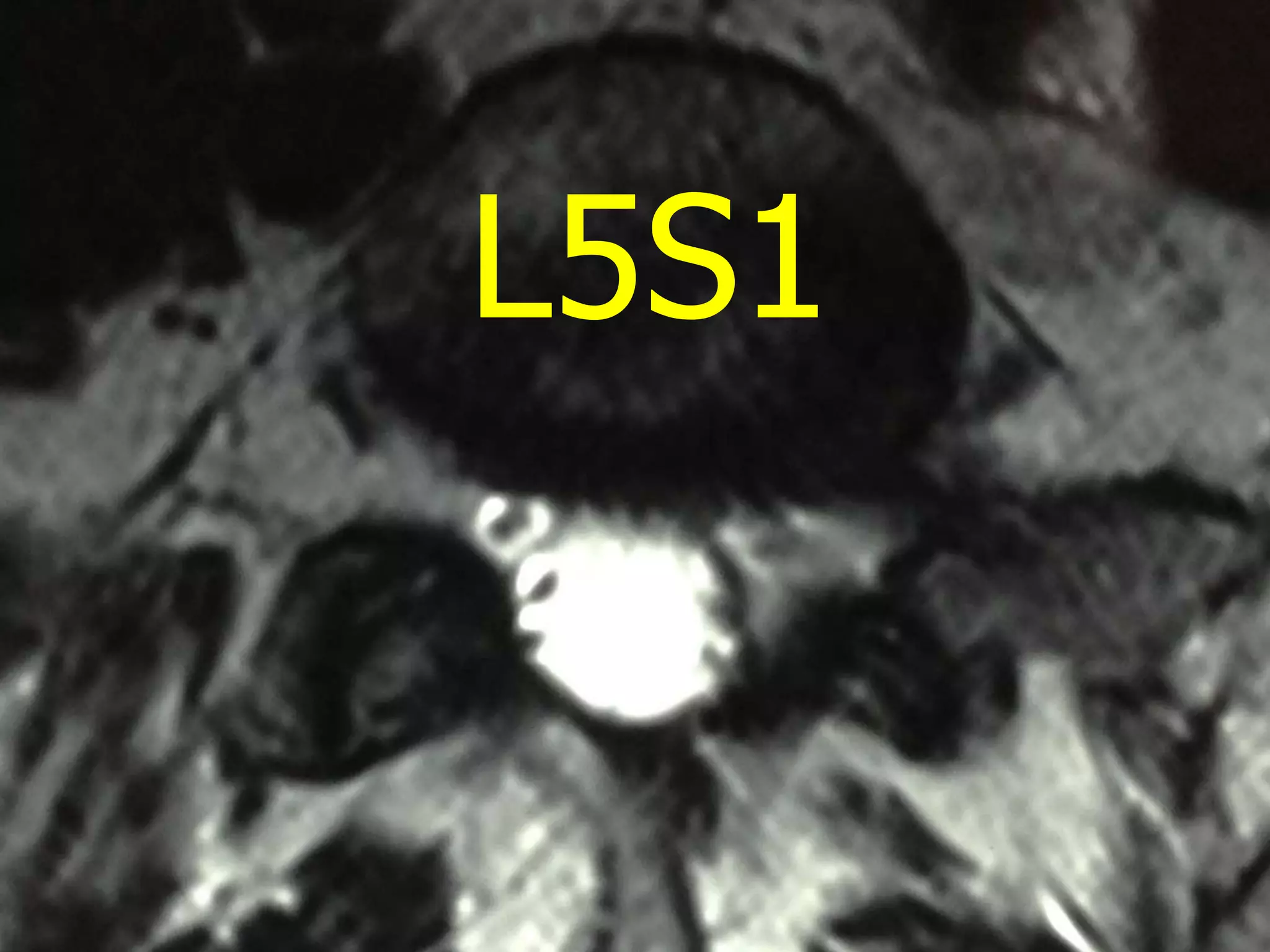 Lumbar Spinal Stenosis ULBD technique | PPTX
