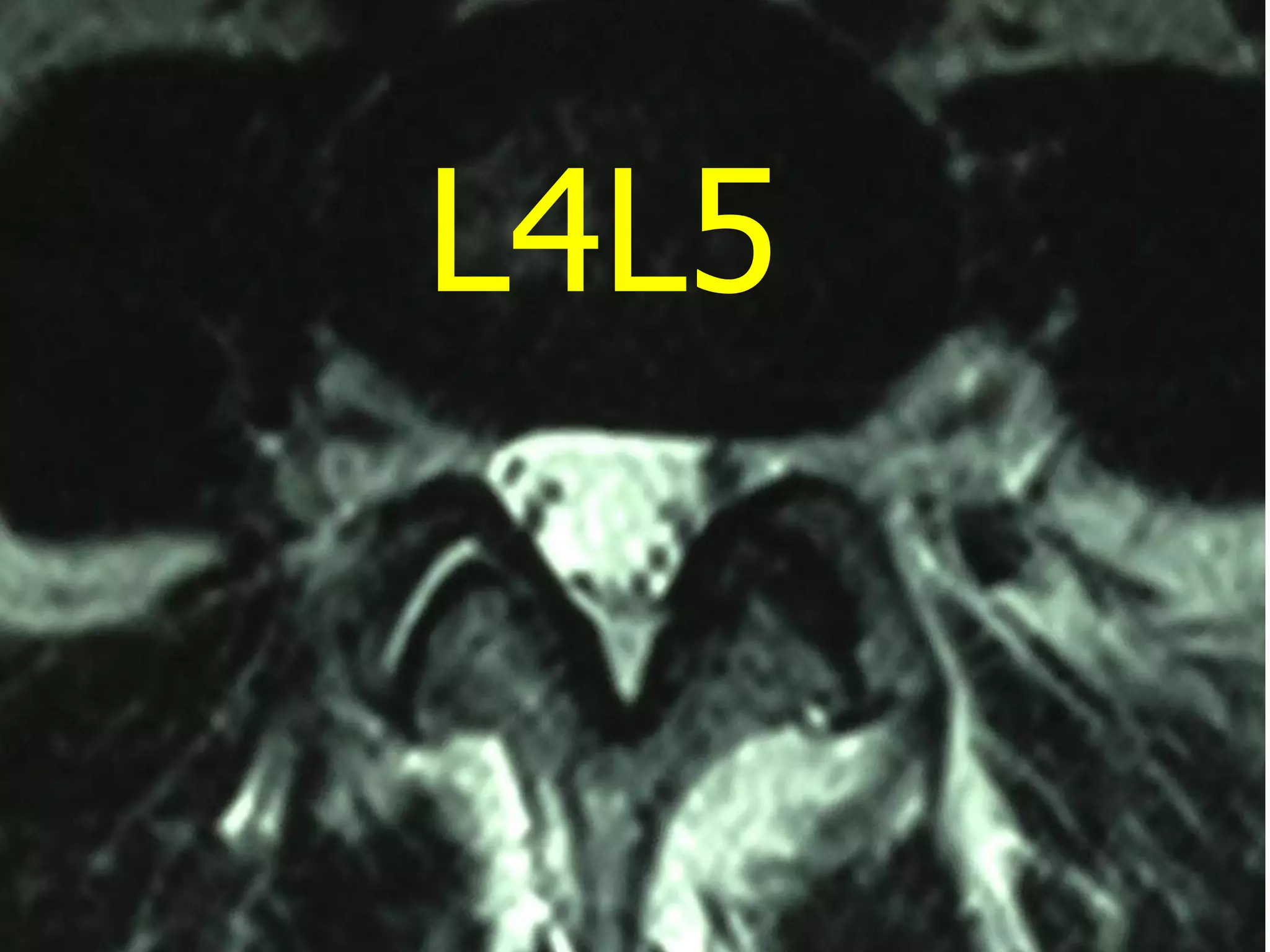 Lumbar Spinal Stenosis ULBD technique | PPTX