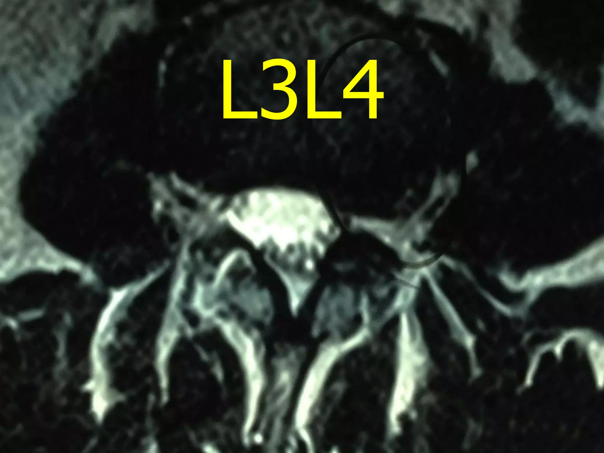 Lumbar Spinal Stenosis ULBD technique | PPTX
