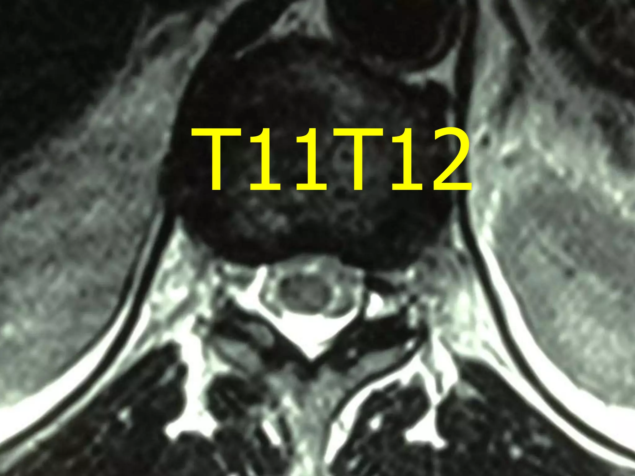 Lumbar Spinal Stenosis ULBD technique | PPTX
