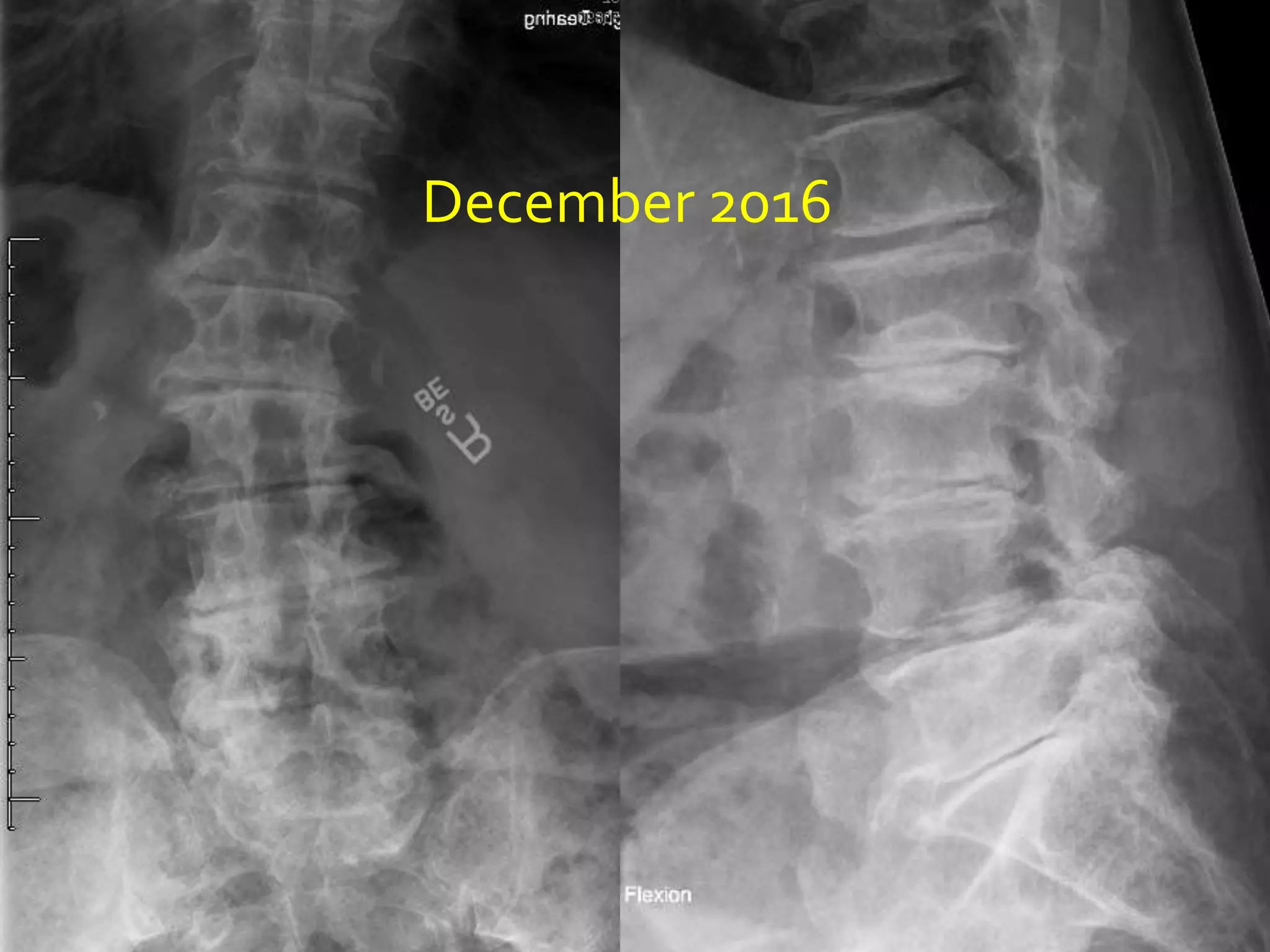 Lumbar Spinal Stenosis ULBD technique | PPT