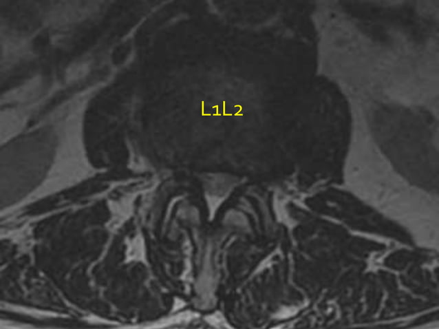 Lumbar Spinal Stenosis ULBD technique | PPTX