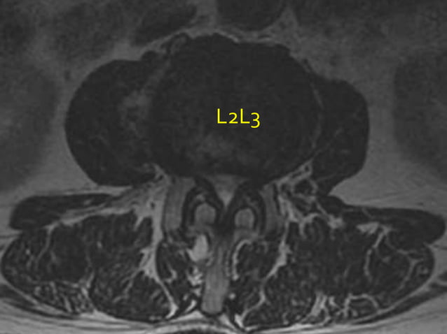 Lumbar Spinal Stenosis ULBD technique | PPTX