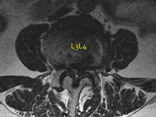 Lumbar Spinal Stenosis ULBD technique | PPTX