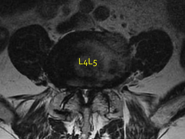 Lumbar Spinal Stenosis ULBD technique | PPTX
