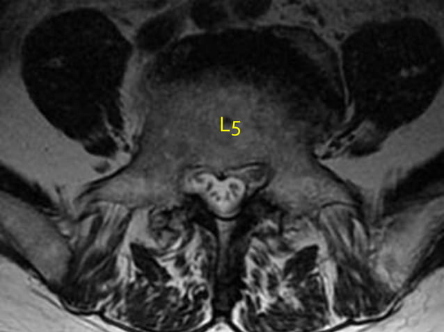 Lumbar Spinal Stenosis ULBD technique | PPTX