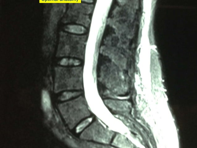 Lumbar Spinal Stenosis ULBD technique | PPTX