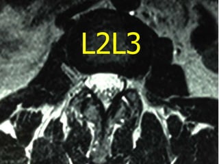 Lumbar Spinal Stenosis ULBD technique | PPTX