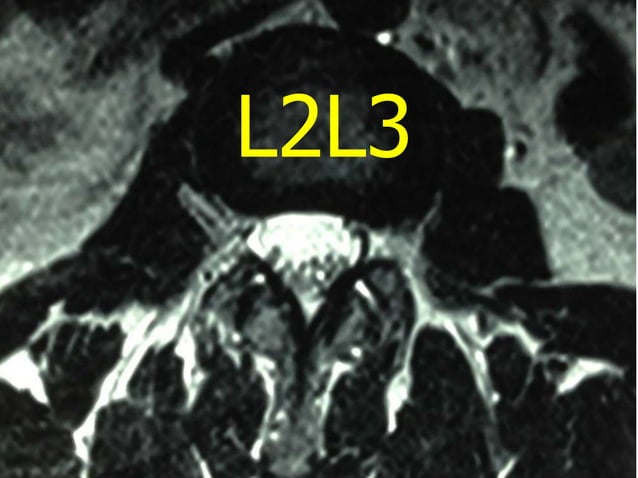 Lumbar Spinal Stenosis ULBD technique | PPTX