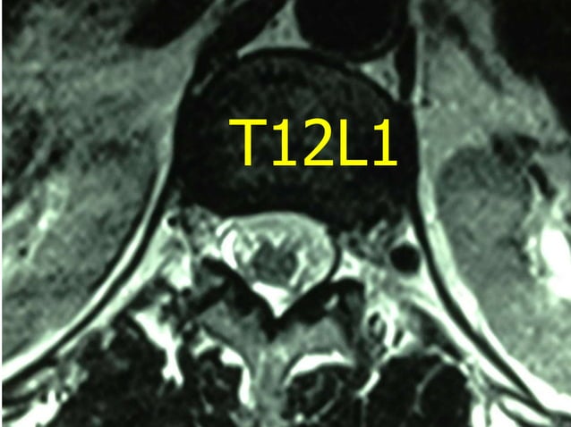 Lumbar Spinal Stenosis ULBD technique | PPTX