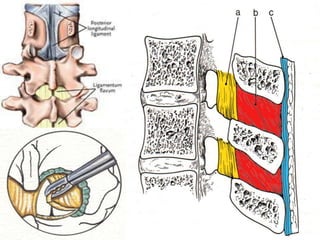 Lumbar Spinal Stenosis ULBD technique | PPTX