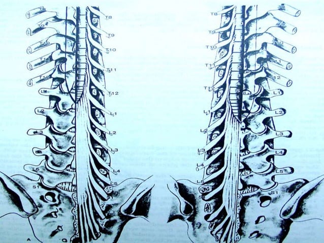 Lumbar Spinal Stenosis ULBD technique | PPTX