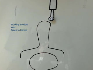 Lumbar Spinal Stenosis ULBD technique | PPTX